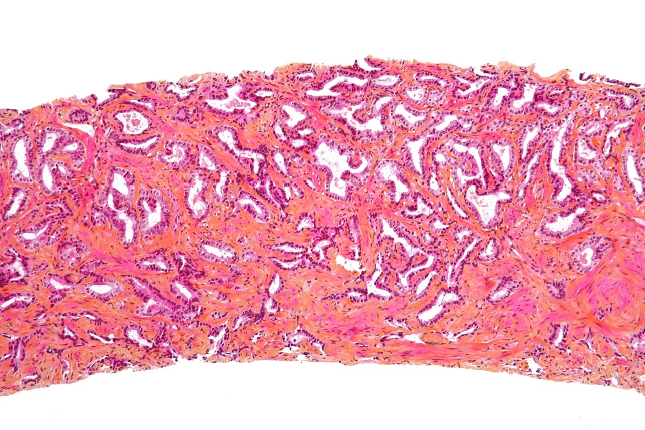 12 Core Prostate Biopsy How To Sample Under Ultrasound Guidance ...